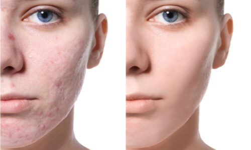 Scar Removal Surgery: Cost, Safety, Effectiveness, And Procedures