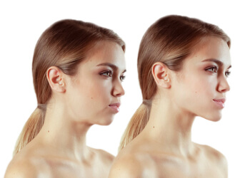 Jaw Alignment Surgery: What to Expect and The procedure - LDA