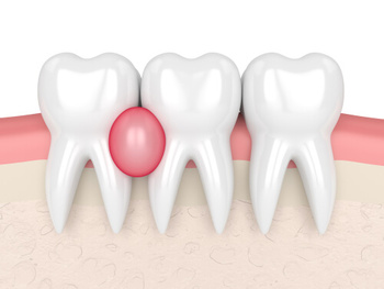 Should I Pop an Abscess on My Gum? Essential Advice and Guidance